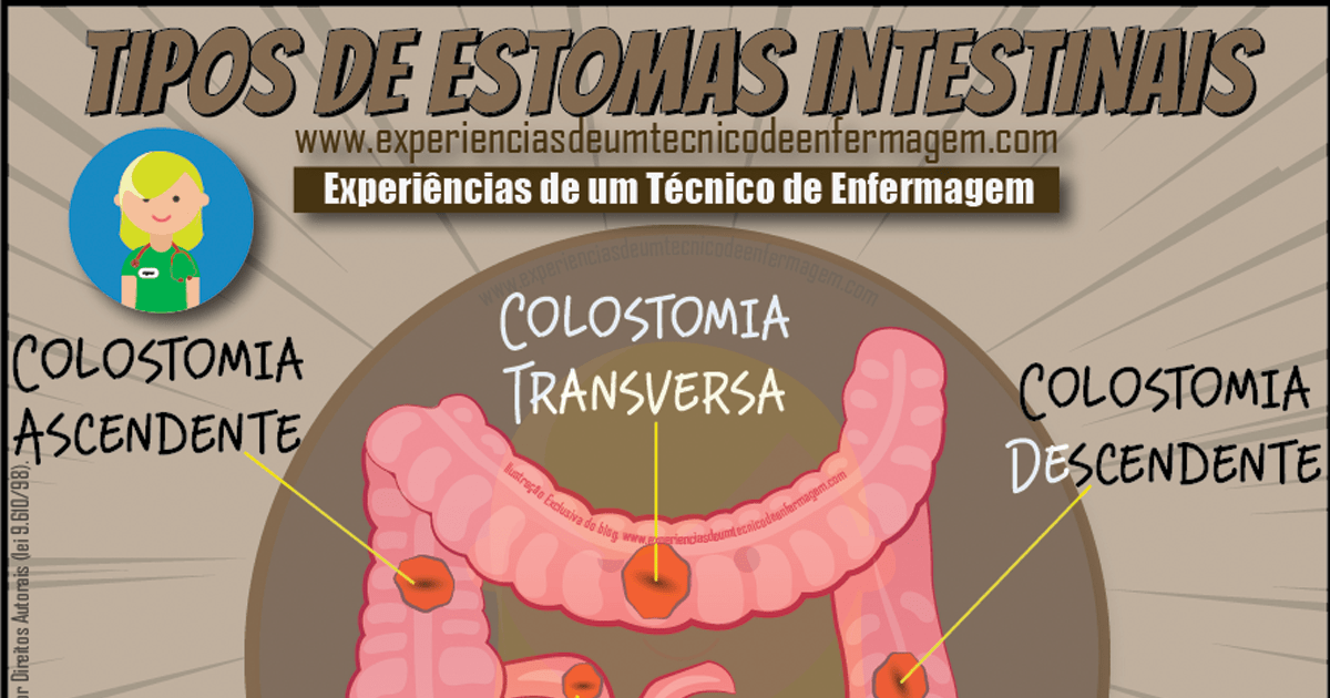 Estomas Intestinais Enfermagem Ilustrada