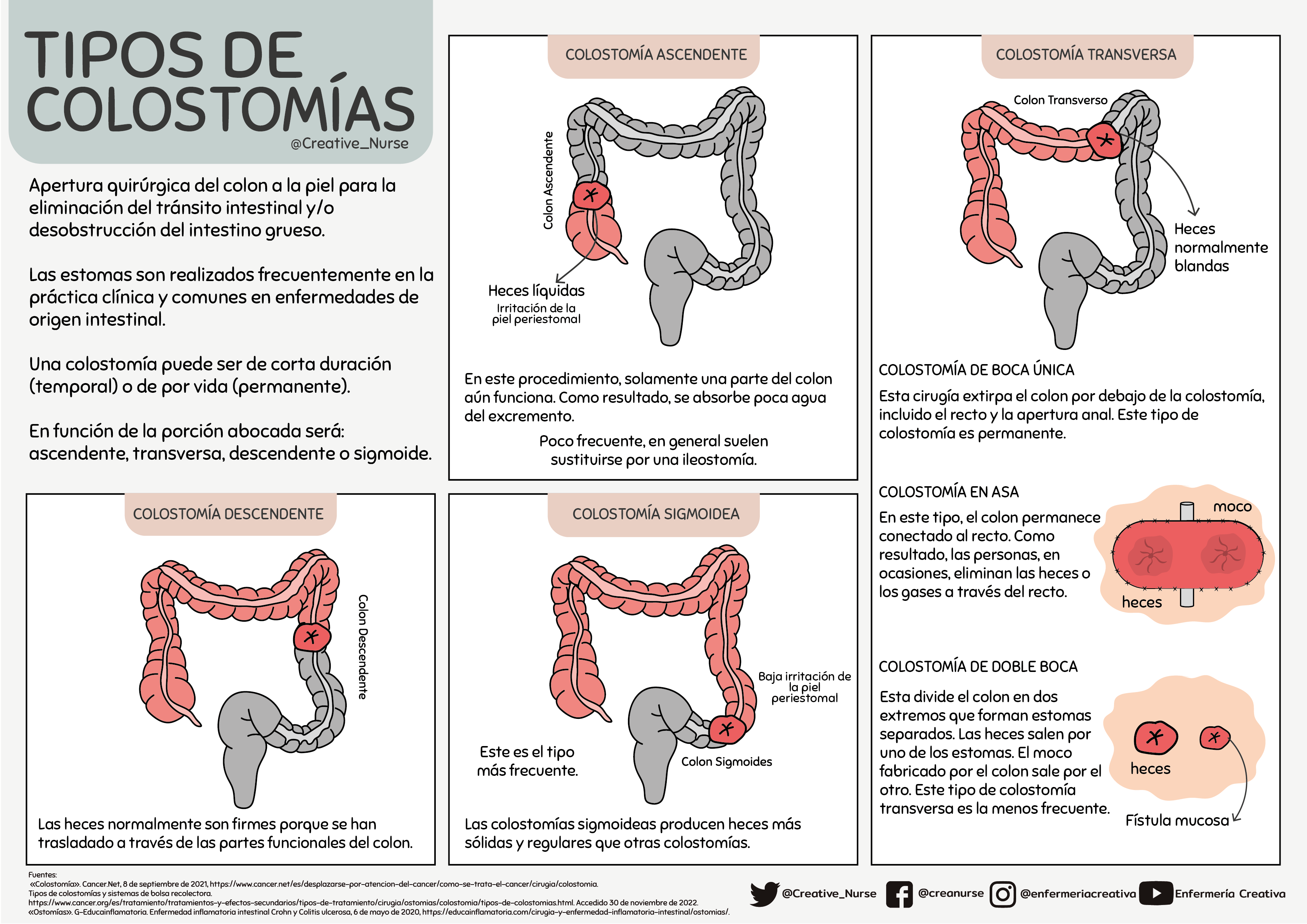 Tipos De Colostomías Enfermería Creativa