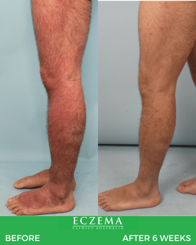 Eczema Specialist Gallery Eczema Clinics Australia