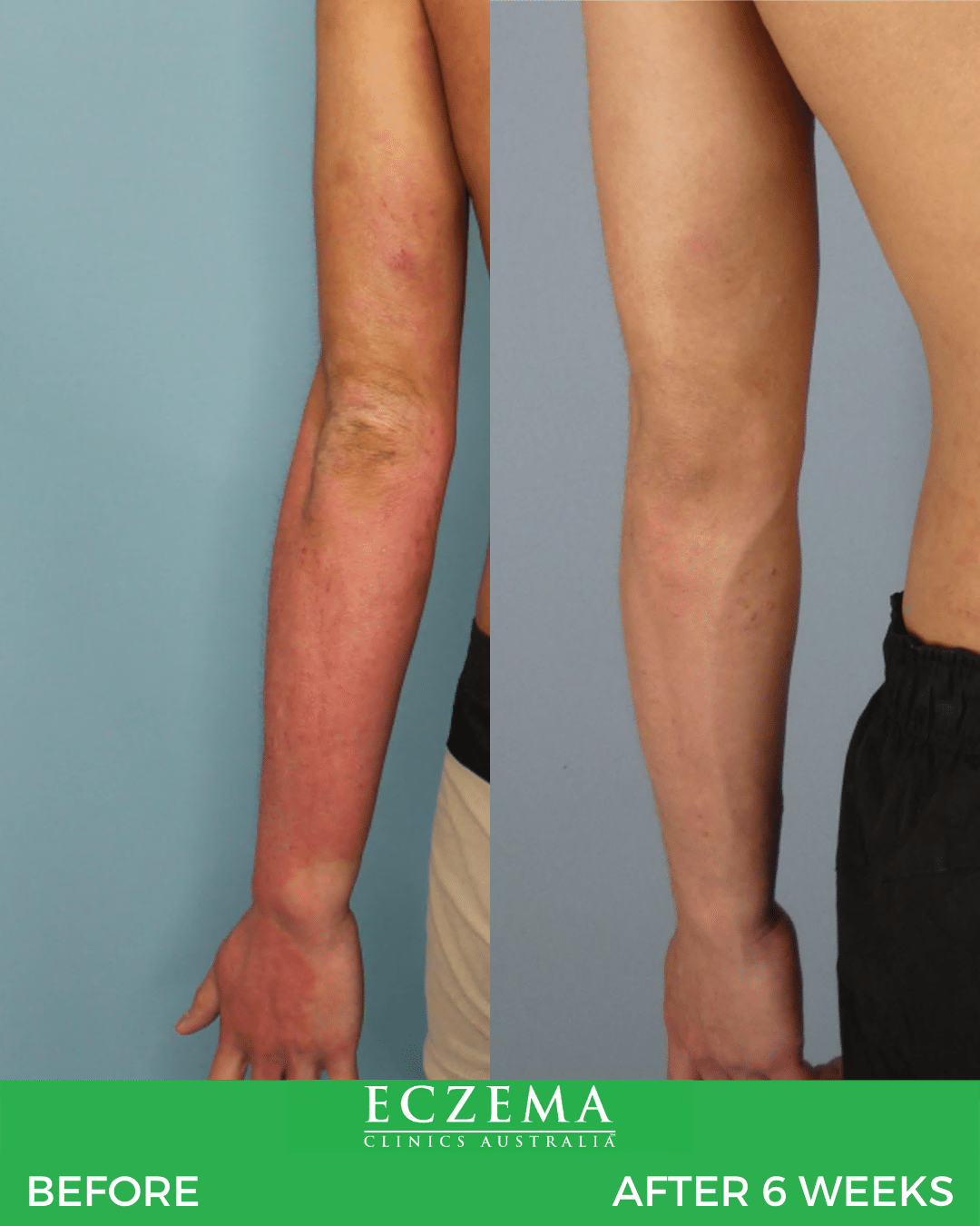 Eczema Specialist Gallery Eczema Clinics Australia