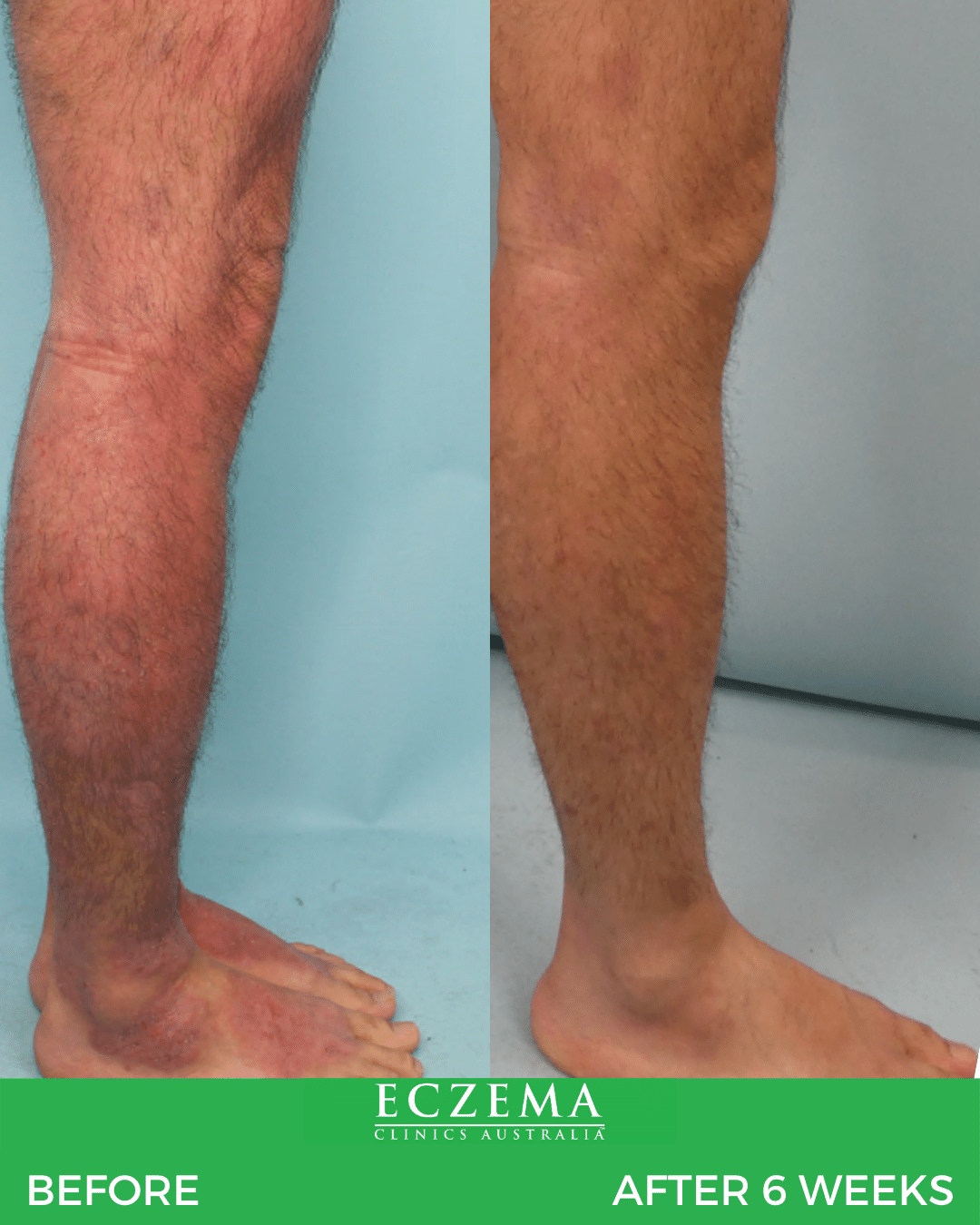 Eczema Specialist Gallery Eczema Clinics Australia