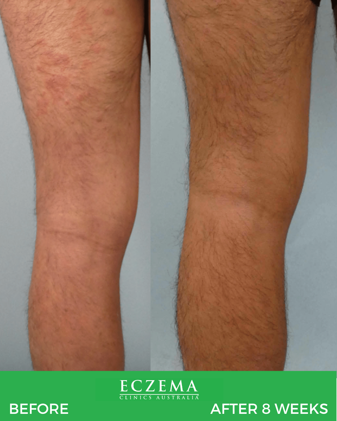 Eczema Specialist Gallery Eczema Clinics Australia