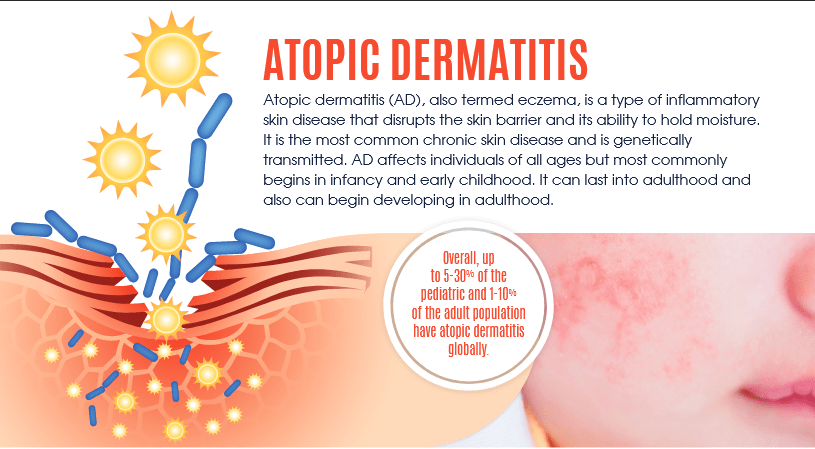 Atopic Dermatitis Eczema Infographic Interesting Facts 2019