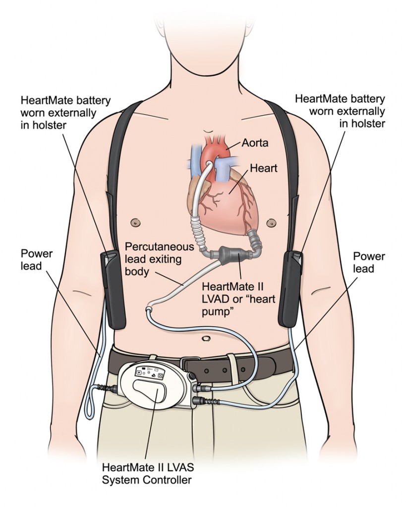 Overview Of Left Ventricular Assist Devices Lvads Ed Ecmo