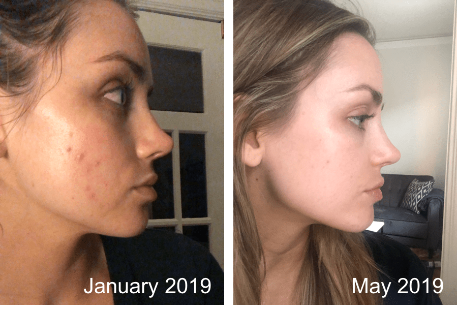 Everything I Did To Heal My Adult Cystic Acne Elyse Wellness