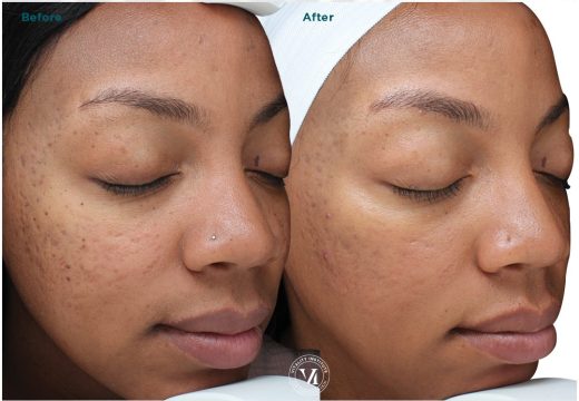 Hyperpigmentation Treatments Best Of Atlanta Winner 2024 Ellemes