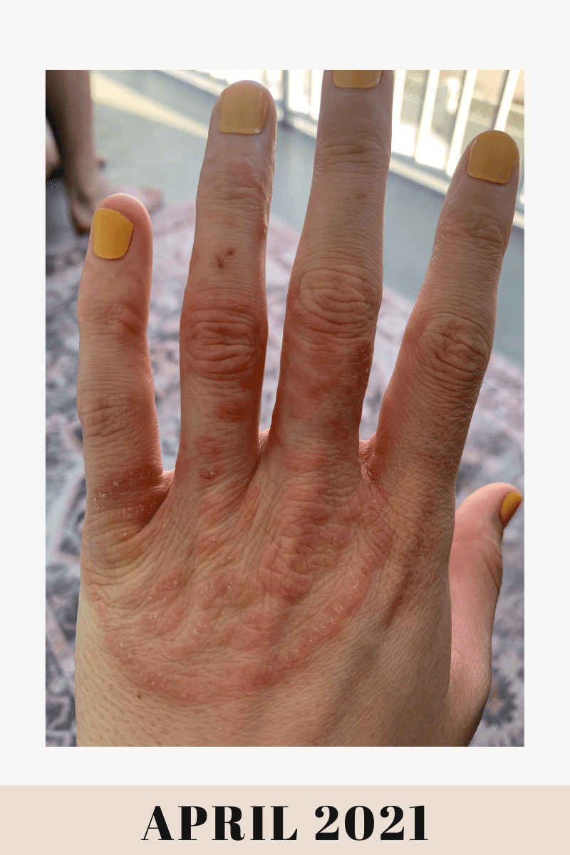 My Experience With Dyshidrotic Eczema Pompholyx Part 2