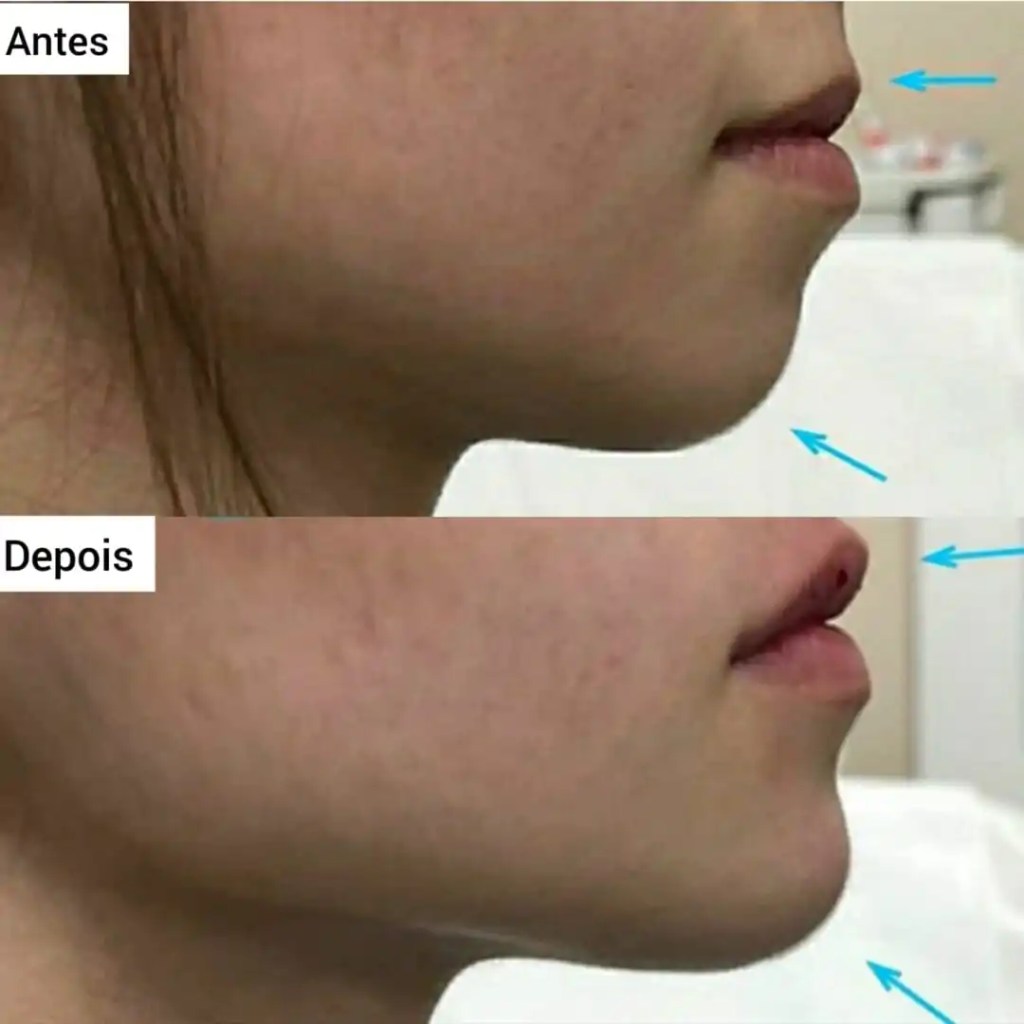 Arquivos Harmonização Facial Mandibular Clínica Fit Body Estética