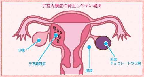 子宮内膜症の病態、症状、陰性所見、診断、治療｜医学的見地から