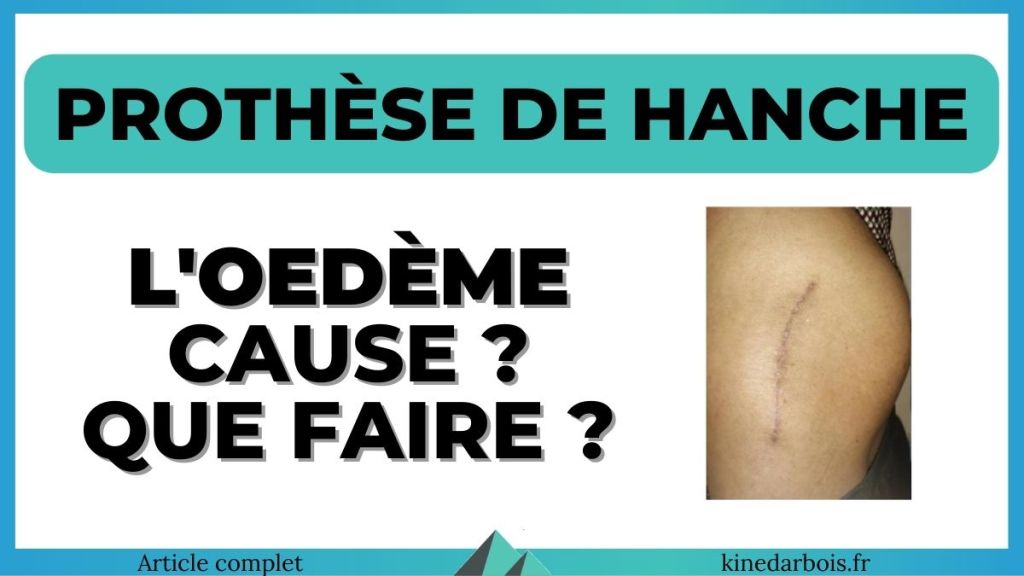 Œdème Après Prothèse De Hanche Que Faire Soyez Rassuré