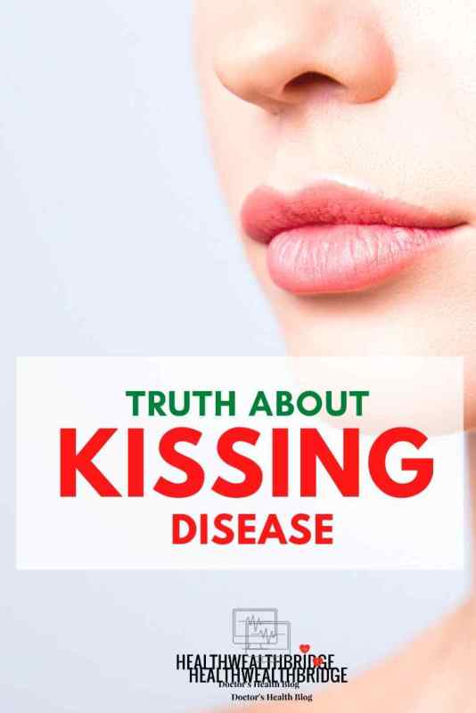 Kissing Disease The Kiss Of The Virus Infectious Mononucleosis