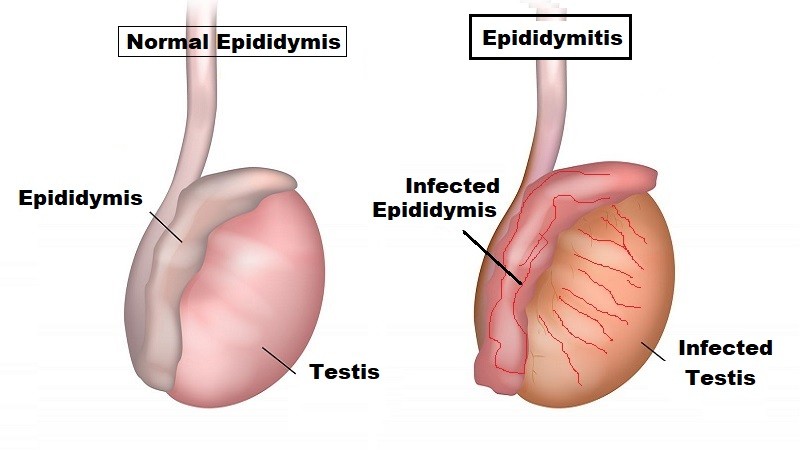 Epididymitis Causes Symptoms And Treatment Helal Medical