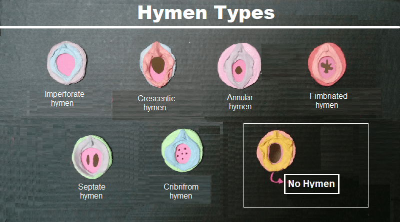 Hymen Types Shapes And Sizes Archives Helal Medical