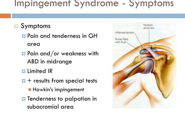 Ppt Shoulder Impingement Syndrome Symptoms Diagnosis Powerpoint