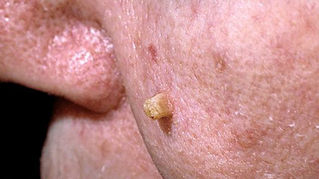 Skin Cancer Rash