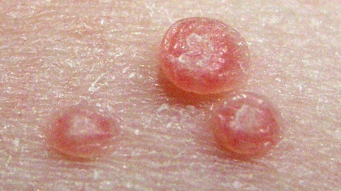 Raised Red Bumps On Skin