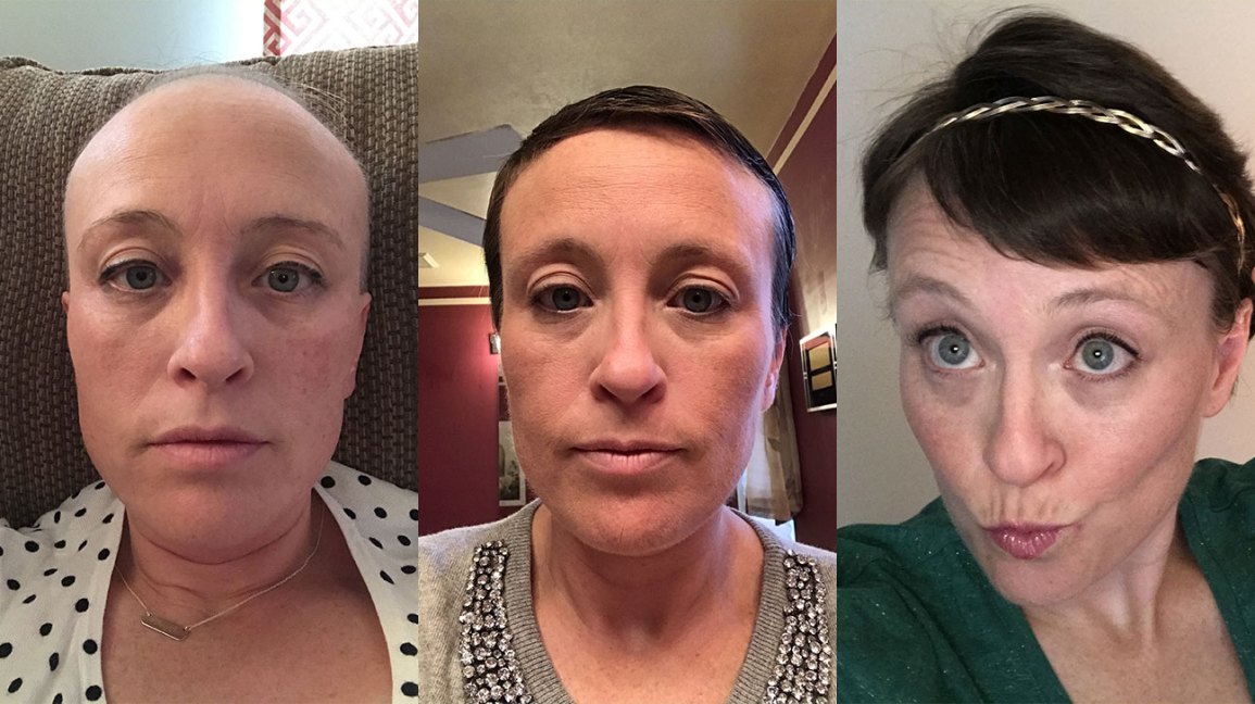 Hair Growth After Chemotherapy Pictures And The Process
