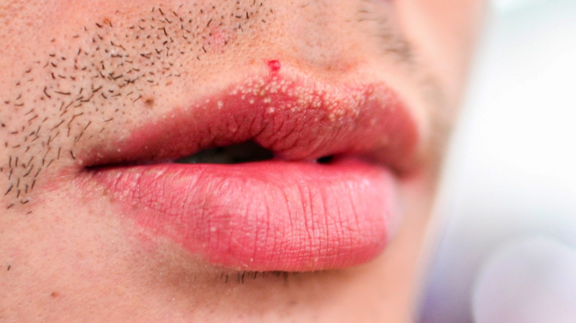 White Spots On Lips Cancer