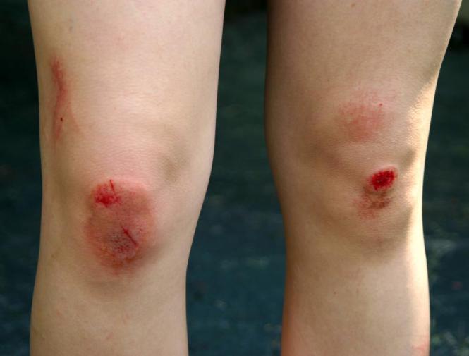 How To Treat Rug Burn On Knees Review Home Co