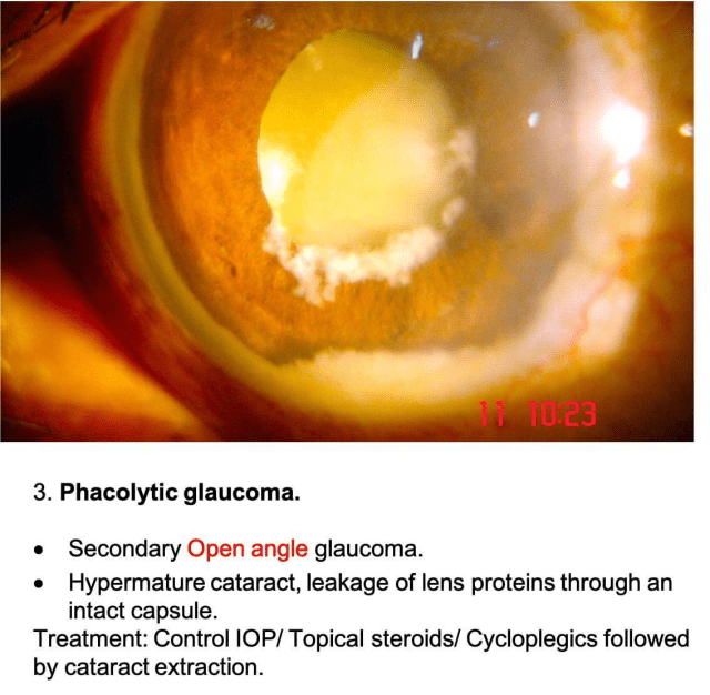 5 Types Of Lens Induced Glaucoma An Eye Care Blog