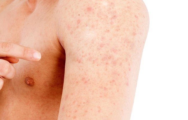 O Que é Eczema Quais São As Causas Os Sintomas E Mais Saúde Blog Opas