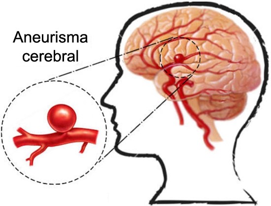 O Que é Aneurisma Cerebral Abdominal Etc Sintomas Tem Cura