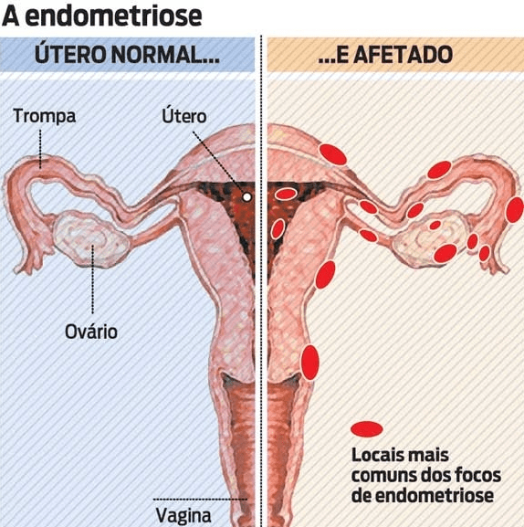 O Que é Endometriose Sintomas Tratamento Cura E Mais Saúde Blog Opas