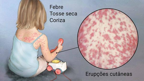 Tudo Sobre Sarampo Sintomas Vacina Tratamento Transmissão E Mais