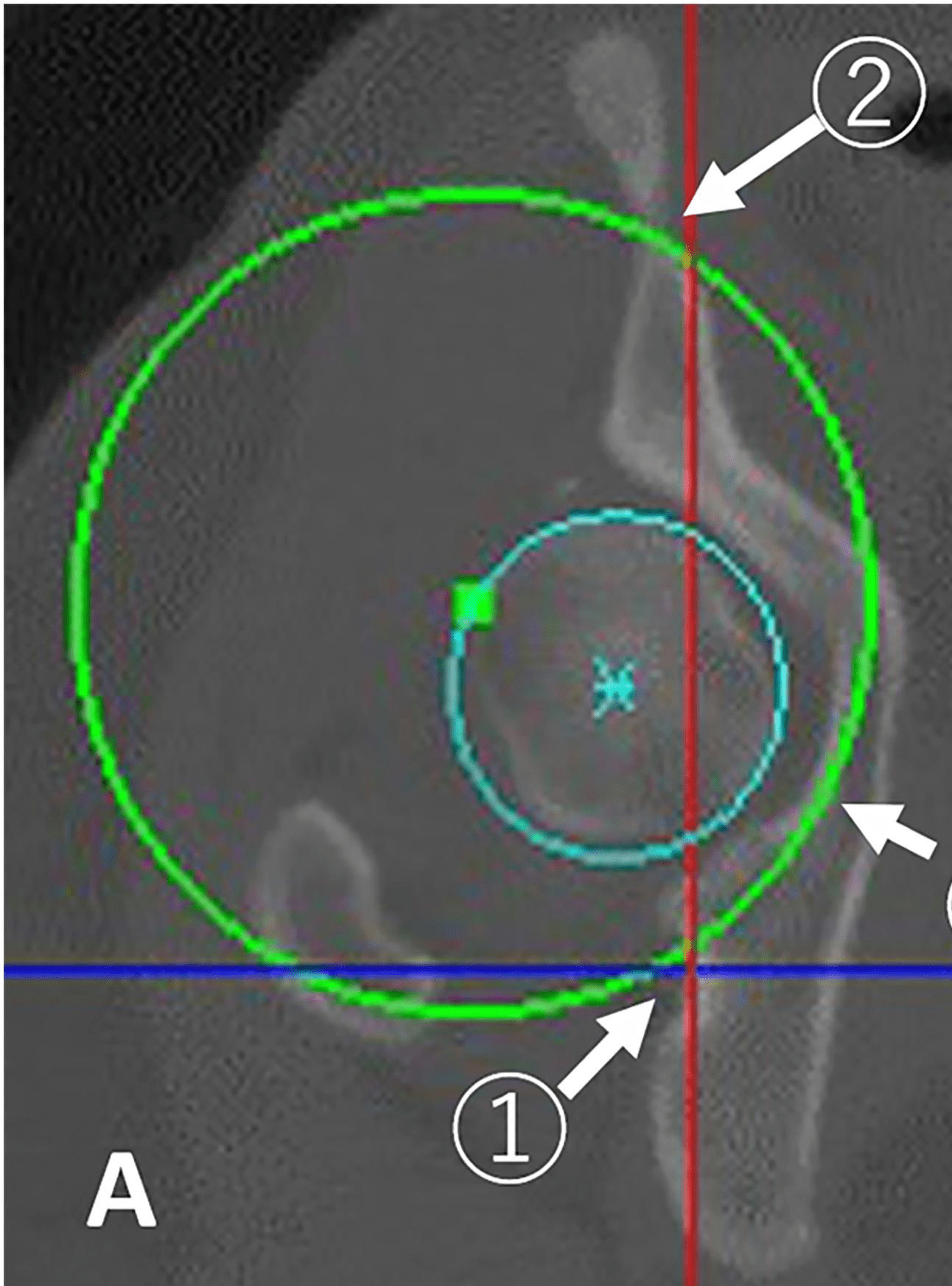 Hip Preservation With A Novel Minimally Invasive Periacetabular