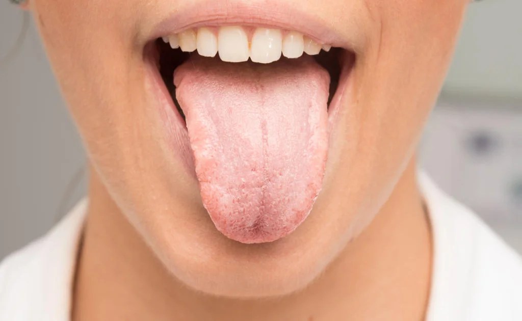 Nighttime Dry Mouth Causes Effects And Prevention