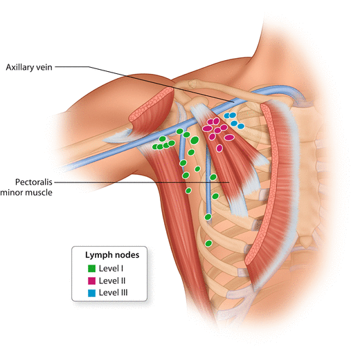 Axillary Node Clearance Oncohema Key