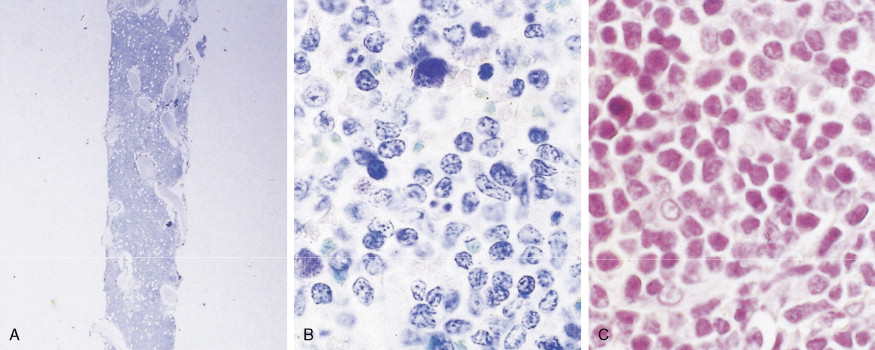 Acute And Chronic Leukemias Oncohema Key