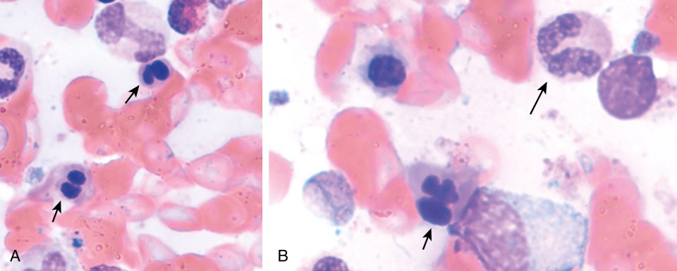 Myeloproliferative Neoplasms Oncohema Key