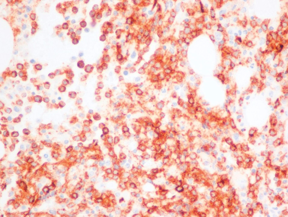 Acute Myeloid Leukemia Oncohema Key