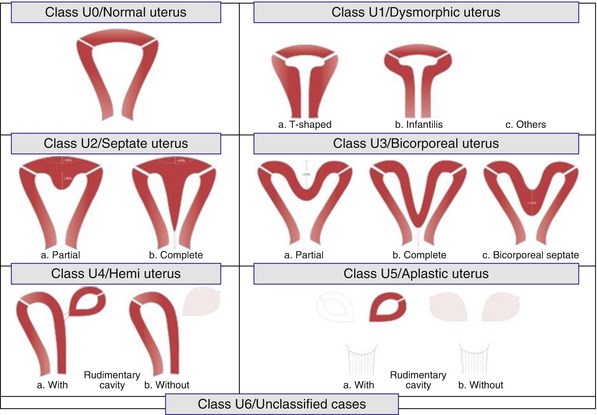 Classification Of Female Genital Malformations Obgyn Key