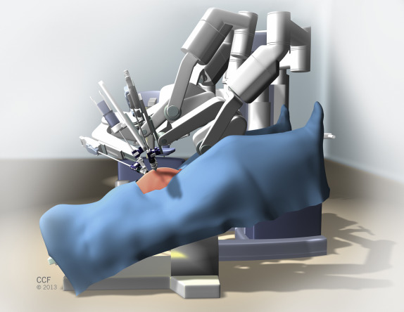 Laparoscopic And Robotic Surgery For Pelvic Organ Prolapse And Stress