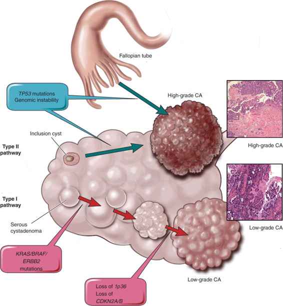 Epithelial Ovarian Cancers Low Malignant Potential And Non Serous