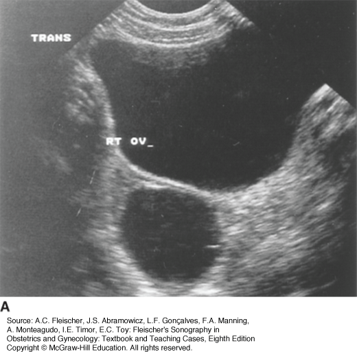 Sonographic Evaluation Of Pelvic Masses Obgyn Key