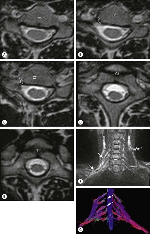 Radiographic Assessment Of Adult Brachial Plexus Injuries Obgyn Key