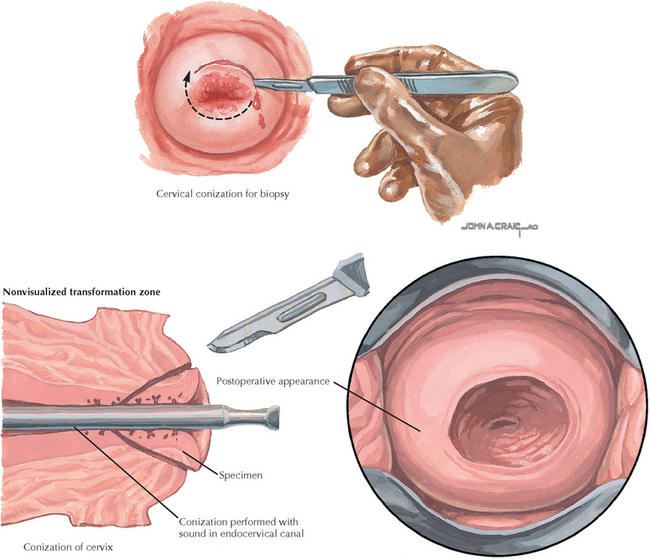 Cervical Conization Cold Knife Obgyn Key