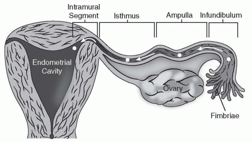 Permanent Contraception Obgyn Key