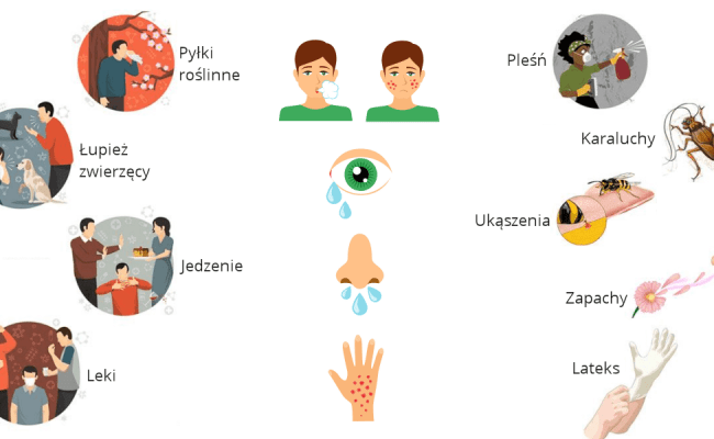 Co To Jest Alergia Rodzaje Przyczyny Objawy I Leczenie Alergii