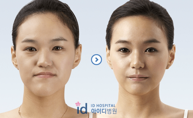 Orthognathic Surgery In Korea Before After Plastic Surgery Otosection