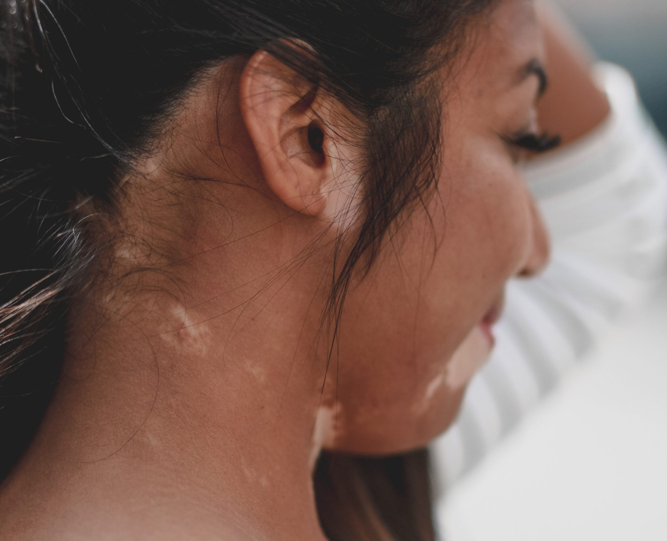 5 Types Of Vitiligo And What They Mean Living Dappled