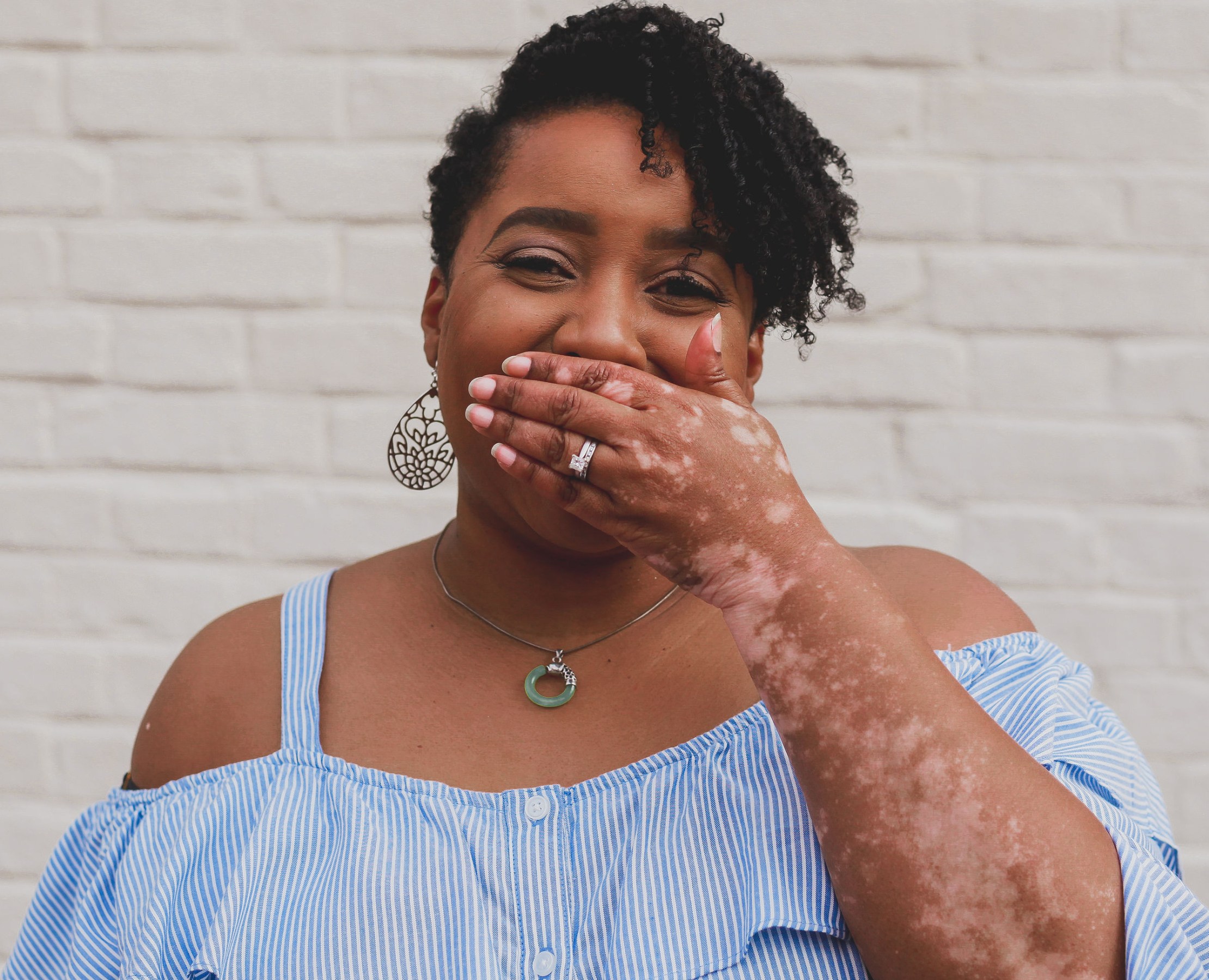 10 Things To Know About Vitiligo Vanquish Living Dappled