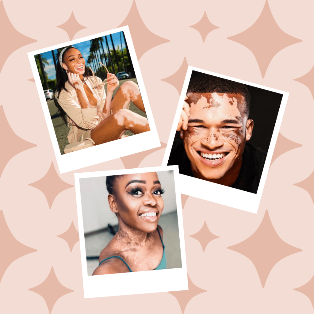 5 Types Of Vitiligo And What They Mean Living Dappled