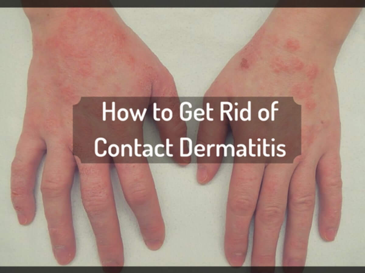 Contact Dermatitis How To Treat And Prevent Them Lifestyle Uganda