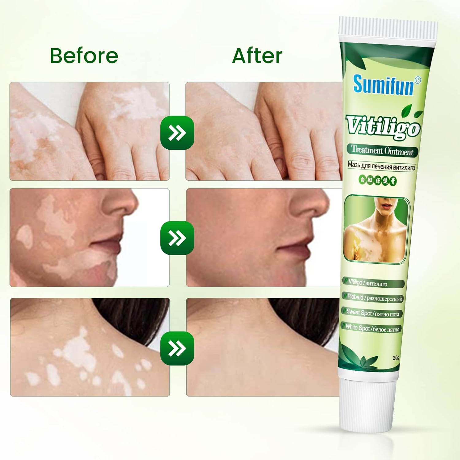 Sumifun Crema De Vitiligo Crema Para El Cuidado Del Vitíligo Psoriasis