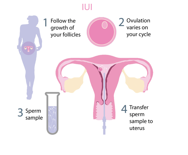 Iui Procedure Step By Step Making Babies In Brooklyn