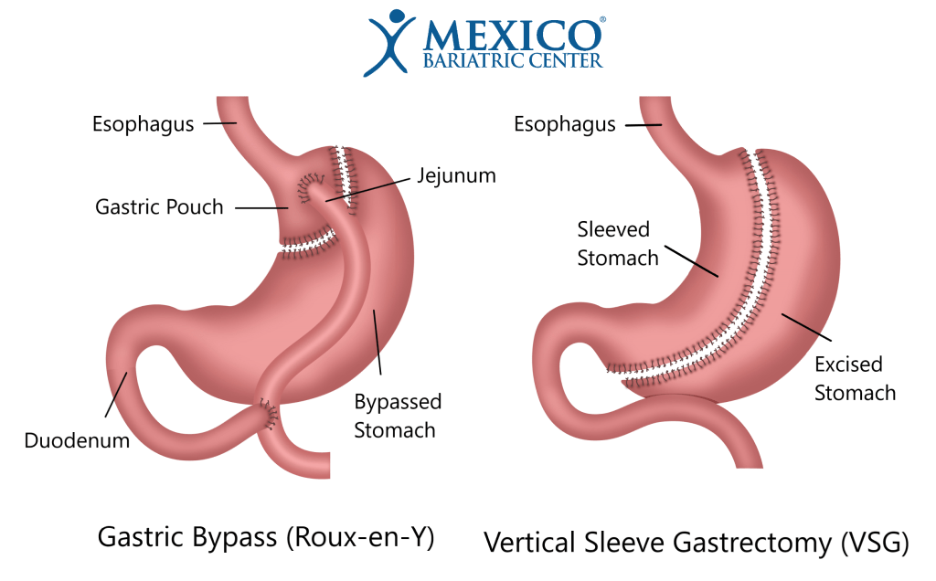 Gastric Sleeve Vs Gastric Bypass Overview 2022